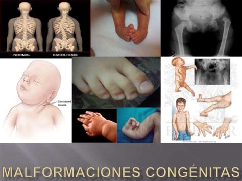 Malformaciones Congénitas