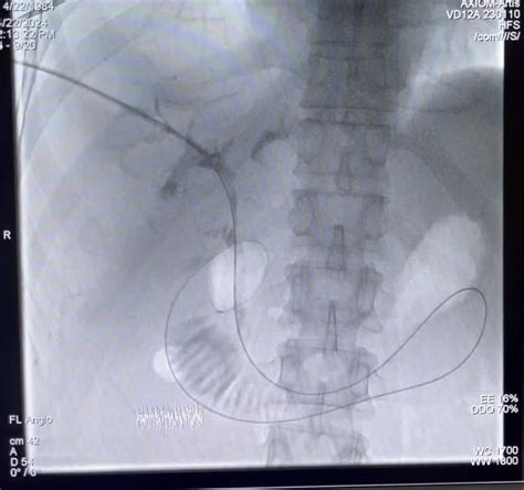 Endoscopic Cholangiography A Technique For Biliary Imaging Fatemeh