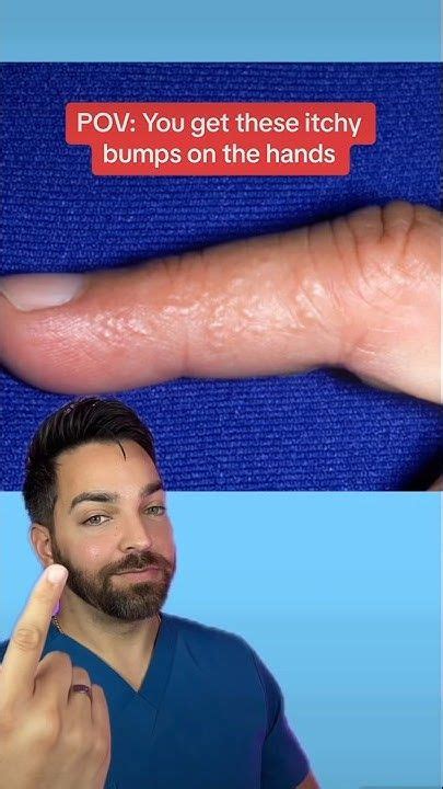 Itchy Bumps On Hands 🤚 Doctorly Shorts Itchy Bumps Itchy Rash