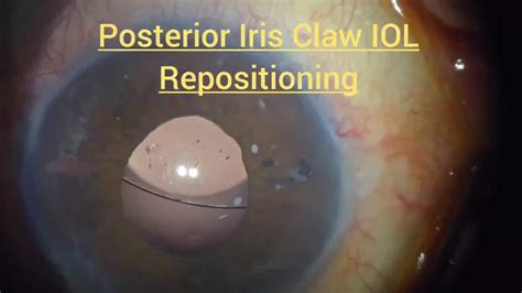 Video Moatez Billah Mekki On Linkedin Irisclawiol Dislocatediol