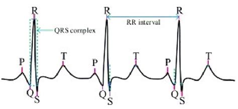 An Illustration Of RR Values And QRS Complexes Download Scientific Diagram