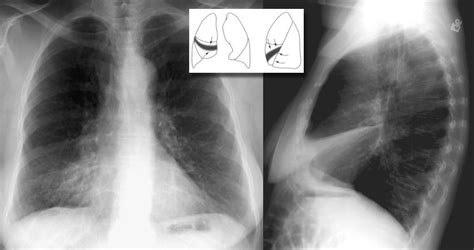 Chest Radiology Radiology Chest Heart Border