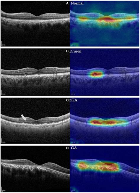 Oct Images And Feature Heatmaps Demonstrating Example Cases Of Normal
