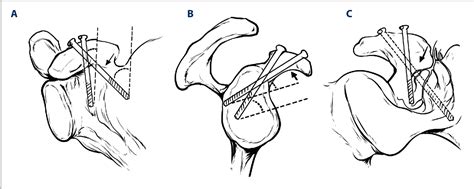 Figure 1 From Coracoid Process Fractures Of The Scapula Treated By Baseplate Three Column