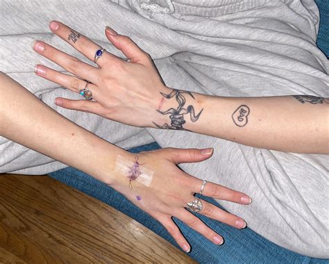 The Process And After Of Being Ganglion Cyst Free Scrolller