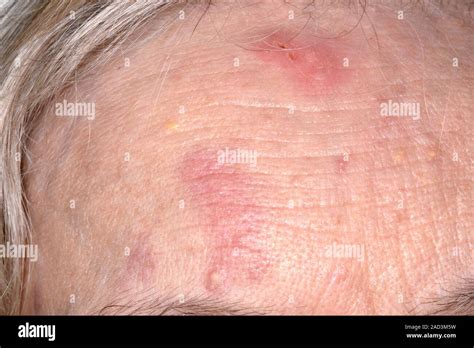 Shingles Rash Close Up Of A Rash On The Forehead Of A 65 Year Old