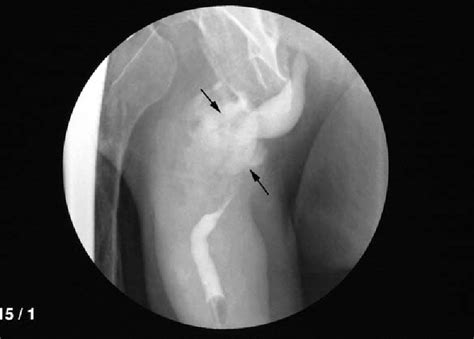 Figure 1 From Superficial Granulomatous Pyoderma Gangrenosum Of The Penis A Case Report