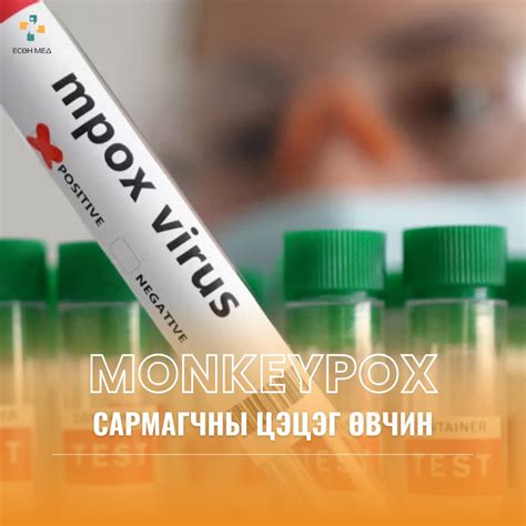 Есөн мед ХХК САРМАГЧНЫ ЦЭЦЭГ ӨВЧИН ГЭЖ ЮУ ВЭ Mpox