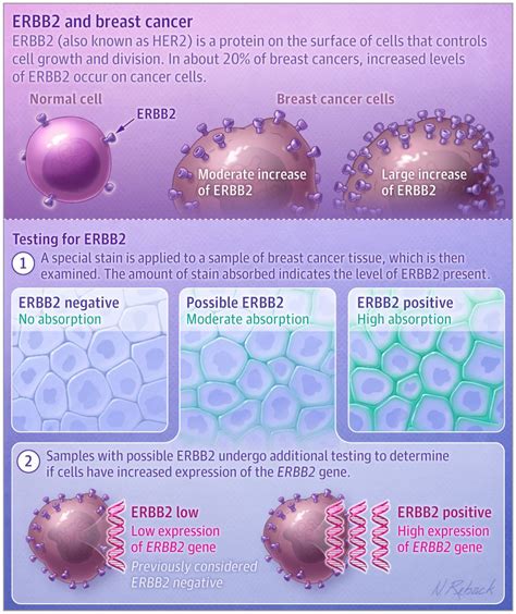 Simone T On Linkedin Her2low Breastcancer Her2