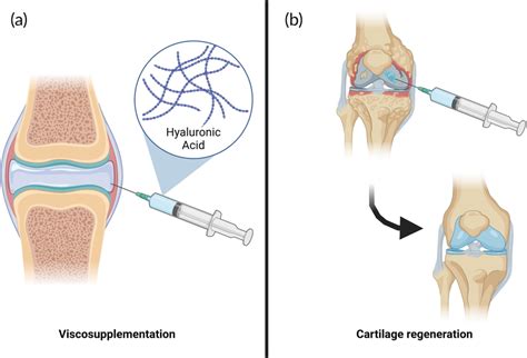 Treatment Of Cartilage Defects Caused By Osteoarthritis A Download Scientific Diagram