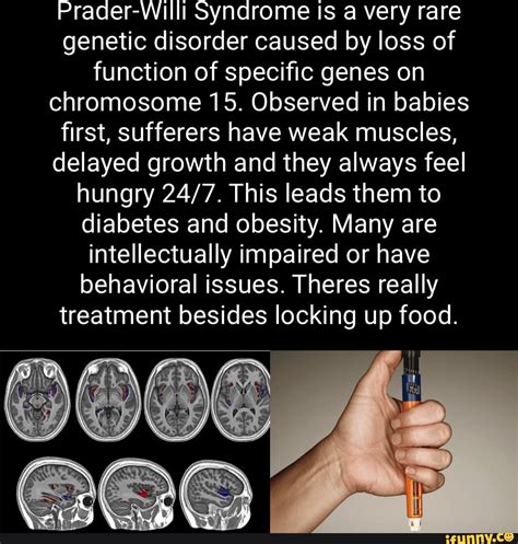 Prader Willi Syndrome Is A Very Rare Genetic Disorder Caused By Loss Of Function Of Specific