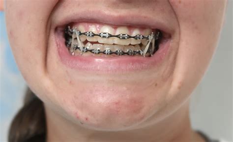 Power Chain Braces Explained Everything You Need To Know