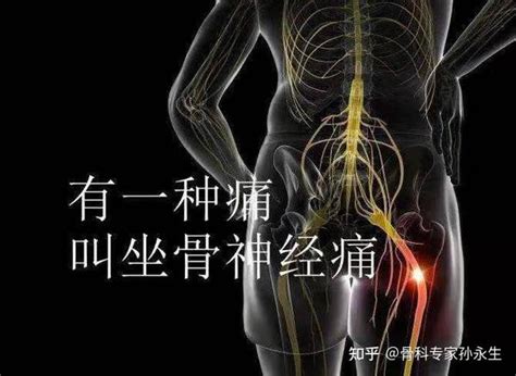 坐骨神经痛久治不愈？牢记这个原则，每天五分钟！ 知乎
