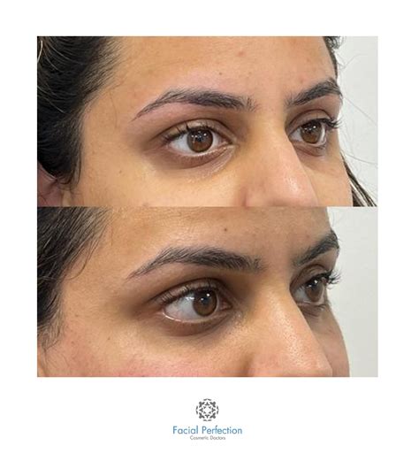 Under Eye Filler For Hollow Eyes Tear Troughs And Eye Bags 47 Off
