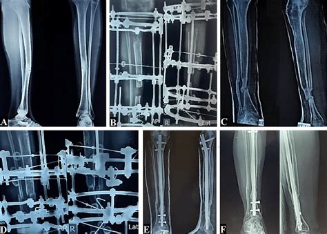 A 145 Year Old Female With Congenital Segmental Tibial Dysplasia