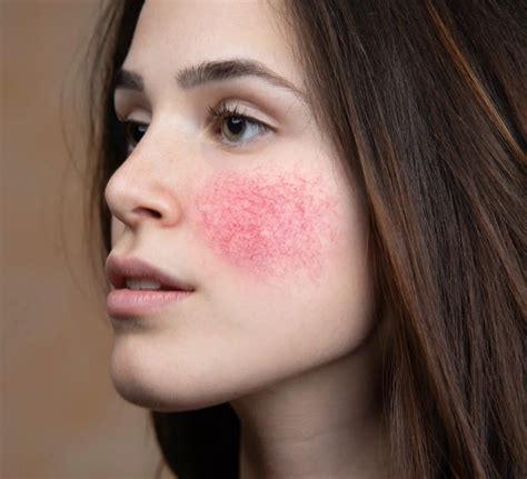 Treat Lupus With Stem Cells Bioxcellerator