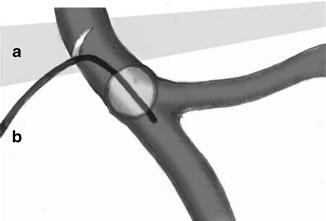 What Is Balloon Occlusion At Sheila Cortes Blog