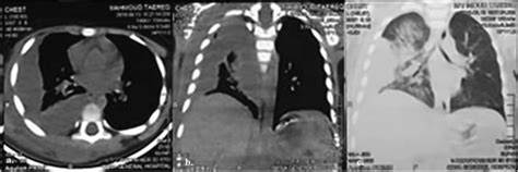 Ct Chest Without Contrast Showing Rt Sided Encysted Empyema And Thick Download Scientific