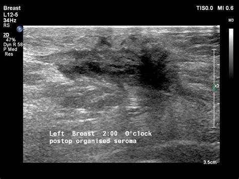 Atlas Of Breast Cancer Early Detection