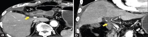 Eus Guided Biliary Drainage In A Patient After Postcholecyst