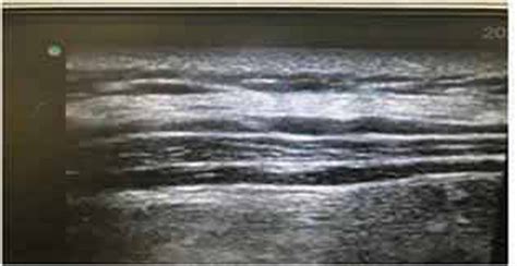 Erector Spinae Block Journal Of Cardiac Critical Care Tss