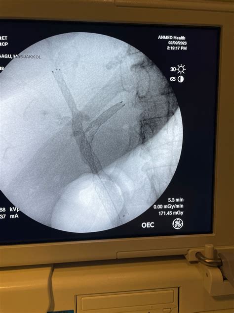 Manjakkollai Veerabagu Md On Linkedin Ercp Cholangiocarcinoma