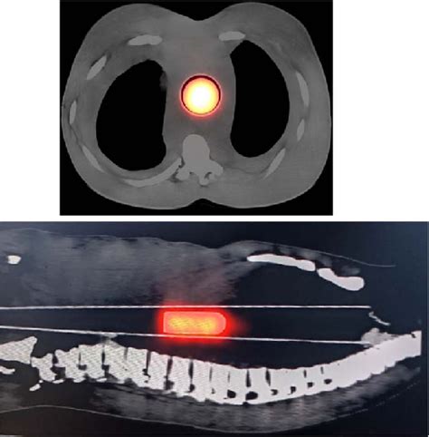 Central Axial Spect Ct Slice Above And Sagital Image Of Abp With