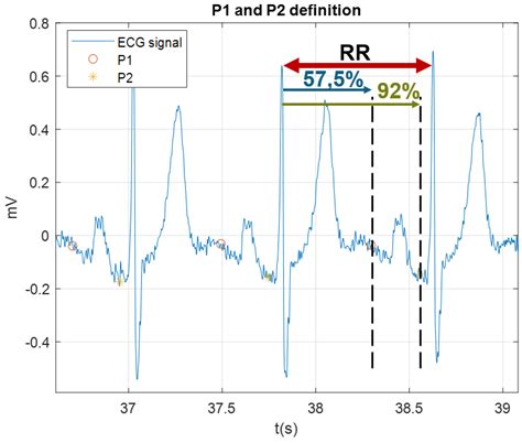 Sensors Free Full Text Lead Reconstruction Using Artificial Neural Networks For Ambulatory