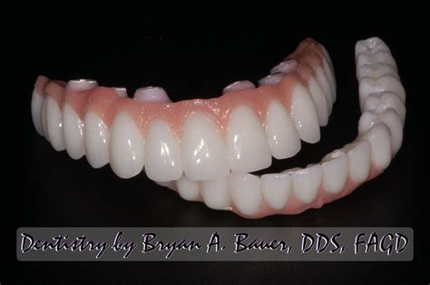 Dental Code Hybrid Denture Locator Denture Code Hybrid Code Bauer Smiles