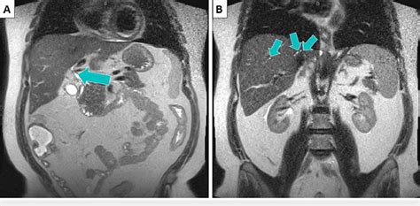 Mrcp Results Blue Arrows Point To The Extrahepatic A And Download Scientific Diagram