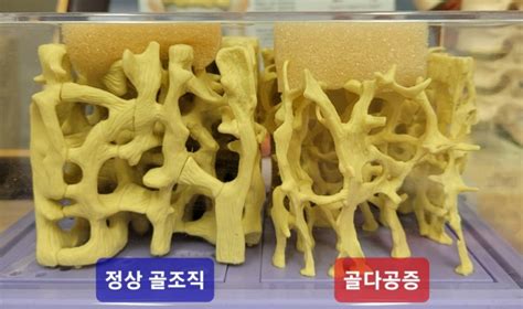 골다공증 진단을 위한 골밀도검사 보험급여가 가능한 경우와 T Score 2 3 골감소증일때 처방과 치료 청구코드 네이버 블로그