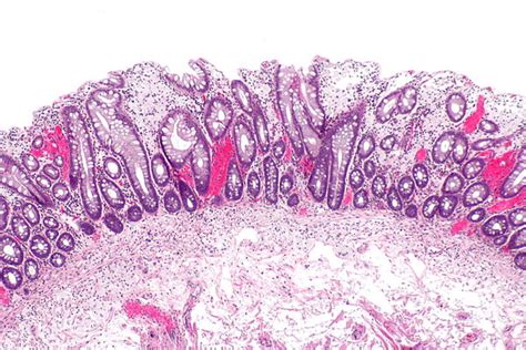 Quiz Gastrointestinal Polyps Libre Pathology