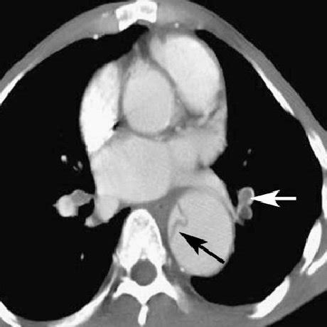 Intermediate Probability V Q Scan Obtained With Dual Head SPECT Using Download Scientific