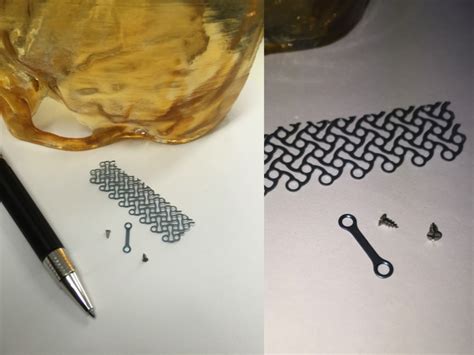 Cranioplasty C N S Neurosurgery