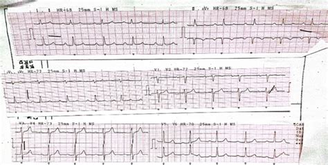 Resting Ecg After The Temporary Pacemaker Was Uninstalled Showing