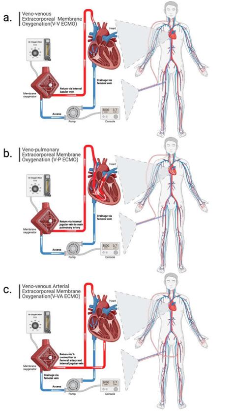 Schematic Demonstrating Configurations For A Veno Venous V V Ecmo Download Scientific