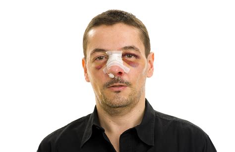 Symptoms Of Broken Nose Bone Aquidneck Chiropractic
