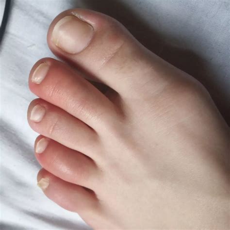 Что это может быть и что делать Покраснели некоторые пальцы на ногах Medaboutme