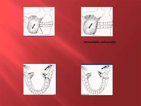 Mandibular Fracturepptx