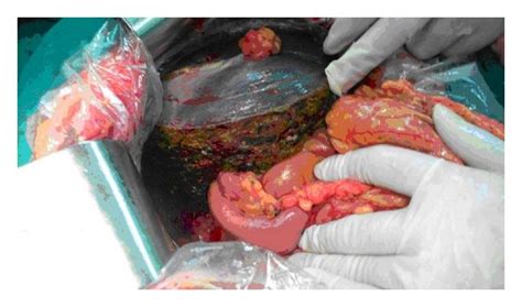 Right Hepatectomy Bile Duct Resection And Left Hepaticojejunostomy Download Scientific Diagram