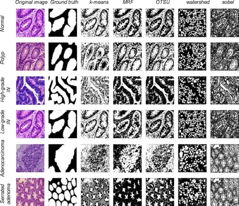 Cancer Detection Models Code And Papers Catalyzex
