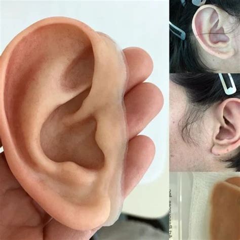 Silicone Ear Prosthesis Osseointegrated Prostheses At ₹ 32000 In Madurai