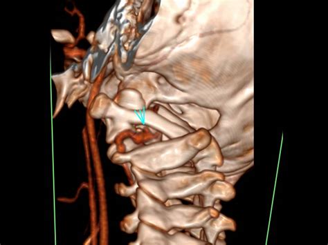 Three Cases Of Vomiting Associated Cervical Artery Dissection