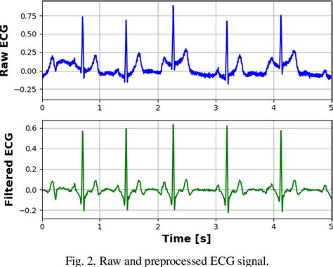 Figure 2 From Linear Regression In Rr Rt Domain For Cardiac Cycle