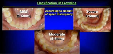 Dental Crowding Space Creation How Do I Fix Them