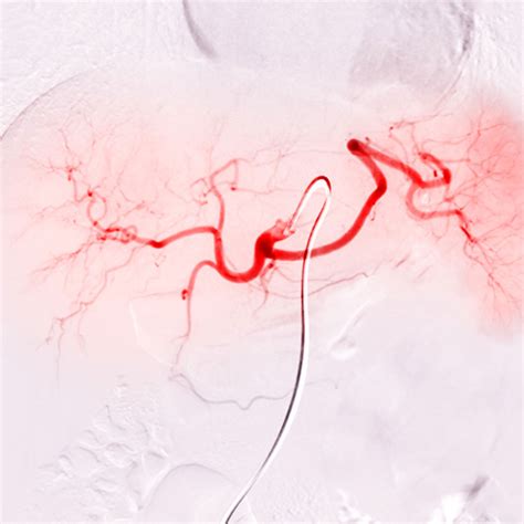Chemoembolization Of Tumors Midwest Radiology