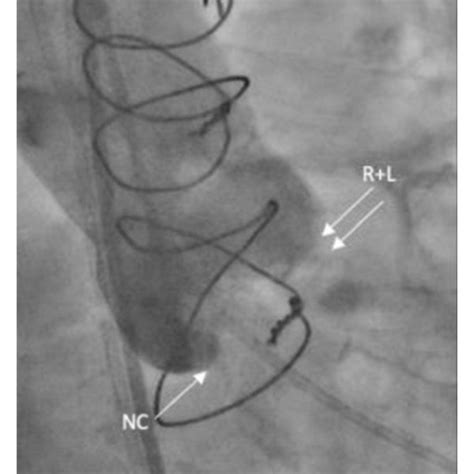 Thv Implantation In The Right And Left Cusp Overlap View A Covl View Download Scientific