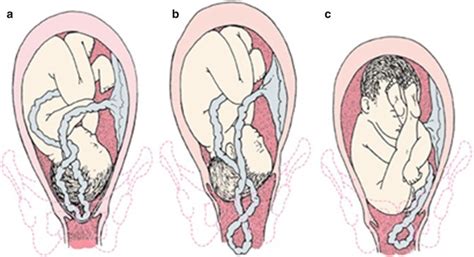 Cord Prolapse Causes Risks And Treatment