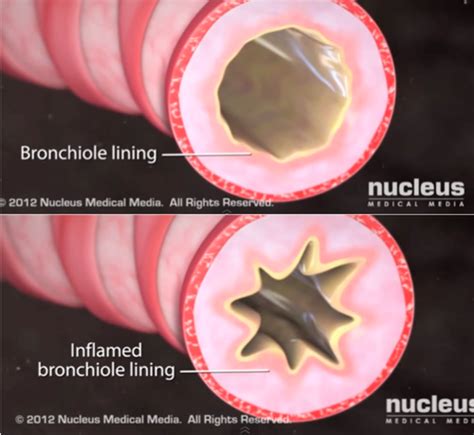 B Asthma Copd And Bronchiectasis Unfinished Flashcards Quizlet
