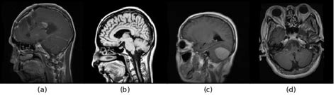 Figure 1 From Automated Multi Class Brain Tumor Classification For Mri Image Using Transfer
